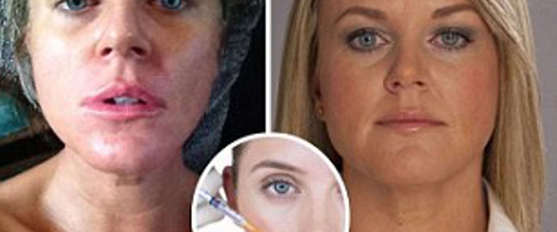 What happens when you stop using fillers?