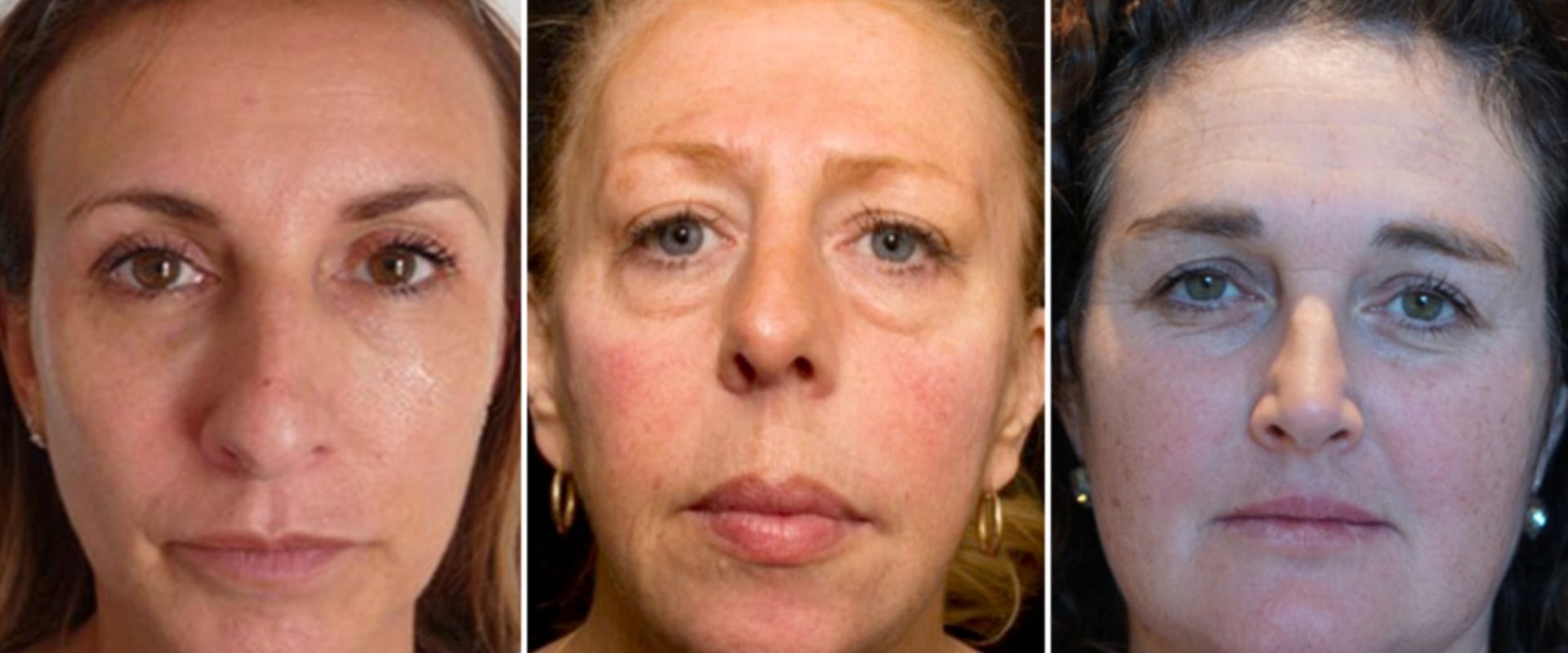 What happens to your skin after years of fillers?